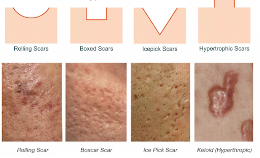 Ketahui 4 Jenis Acne Scars dan Cara Perawatannya - ST Indonesia