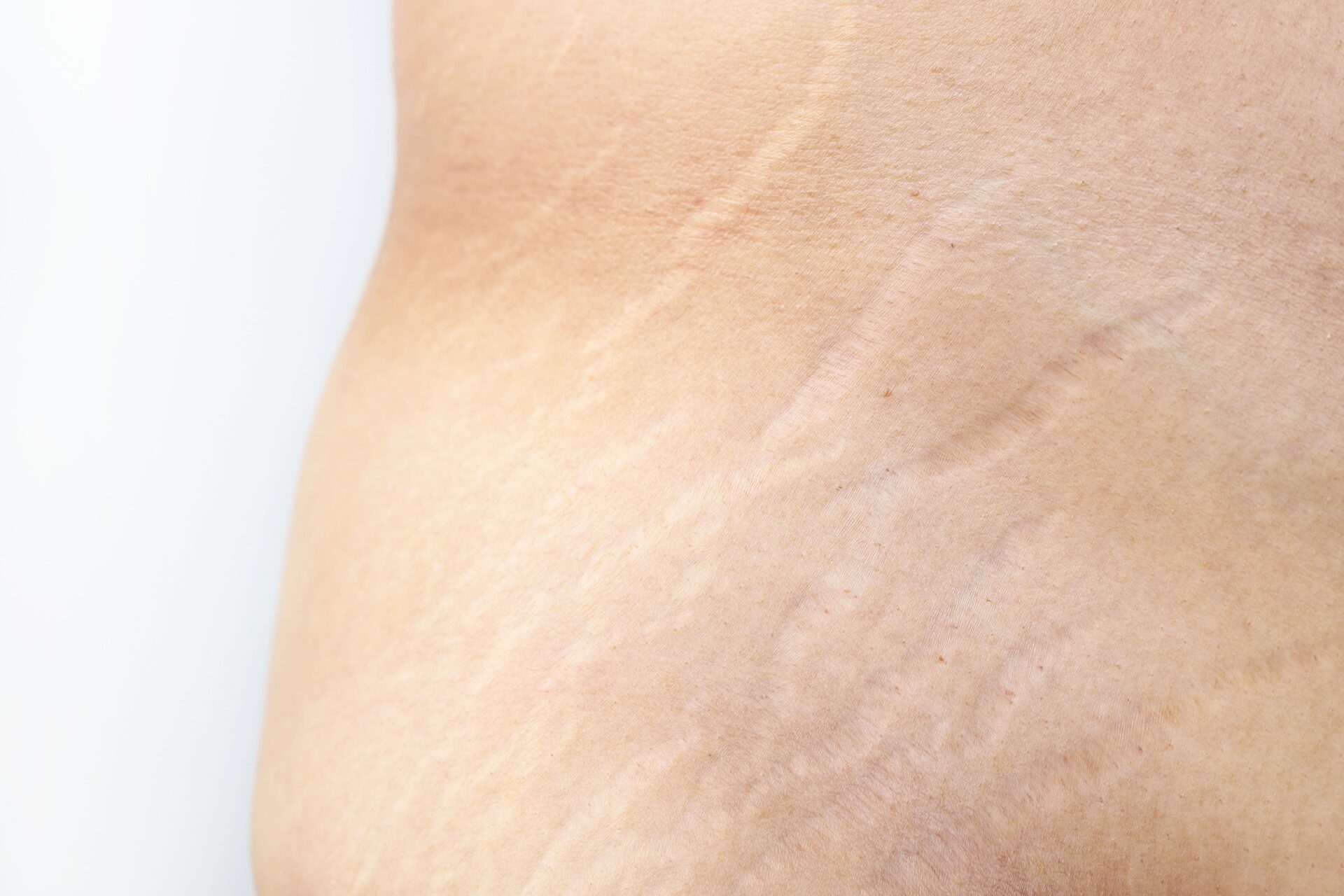 Stretch Mark Merusak Kepercayaan Diri? Begini Cara Menghilangkannya ...