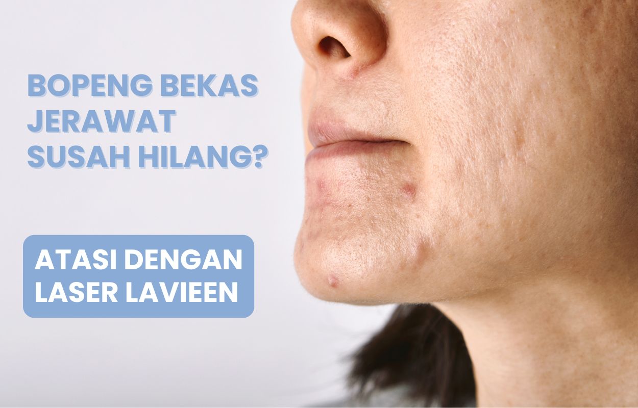 Laser Bopeng: Solusi Ampuh Hilangkan Bekas Jerawat untuk Kulit Mulus ...