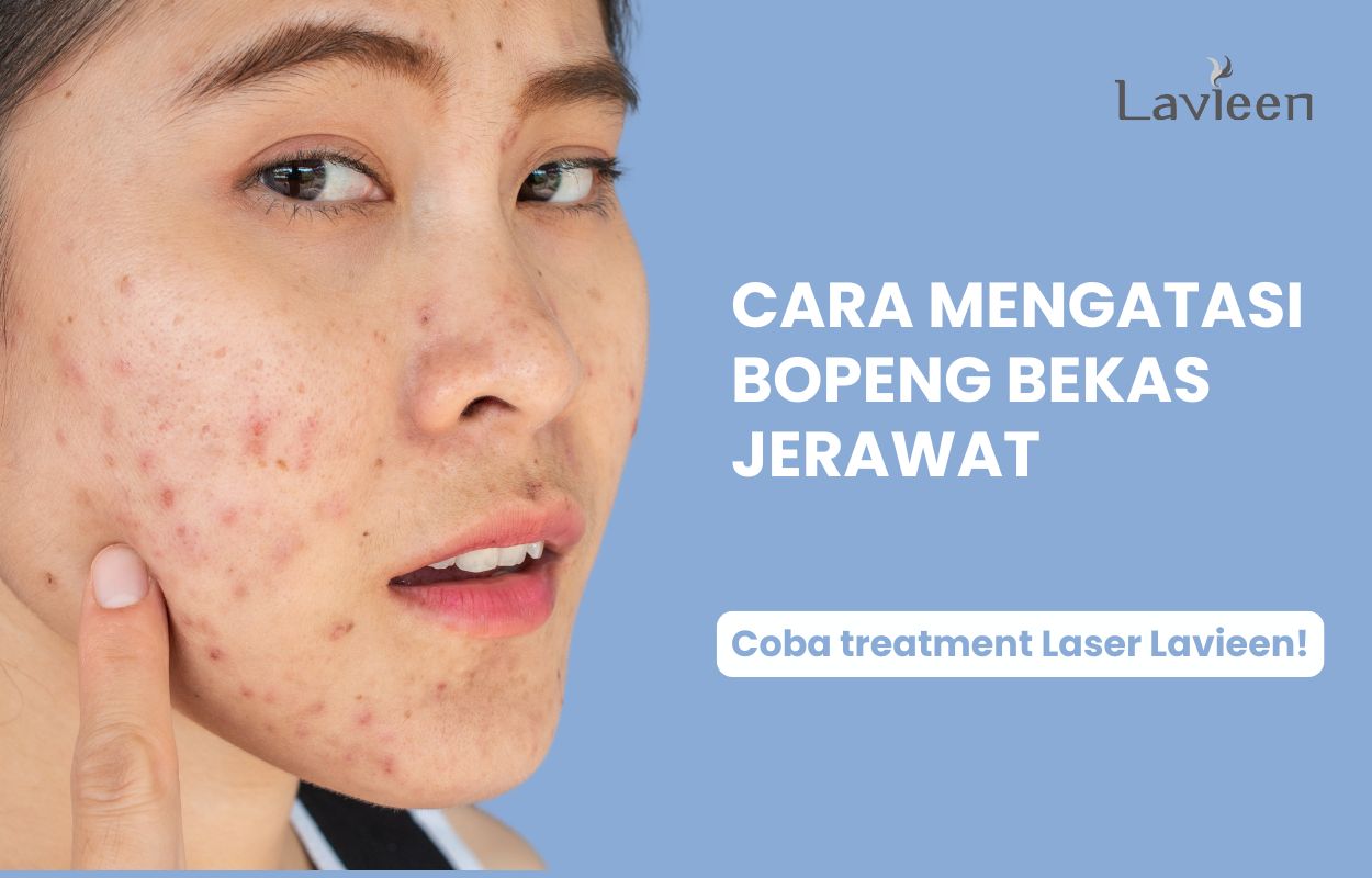 Laser Wajah Bopeng: Cara Ampuh Mengatasi Bekas Jerawat - ST Indonesia