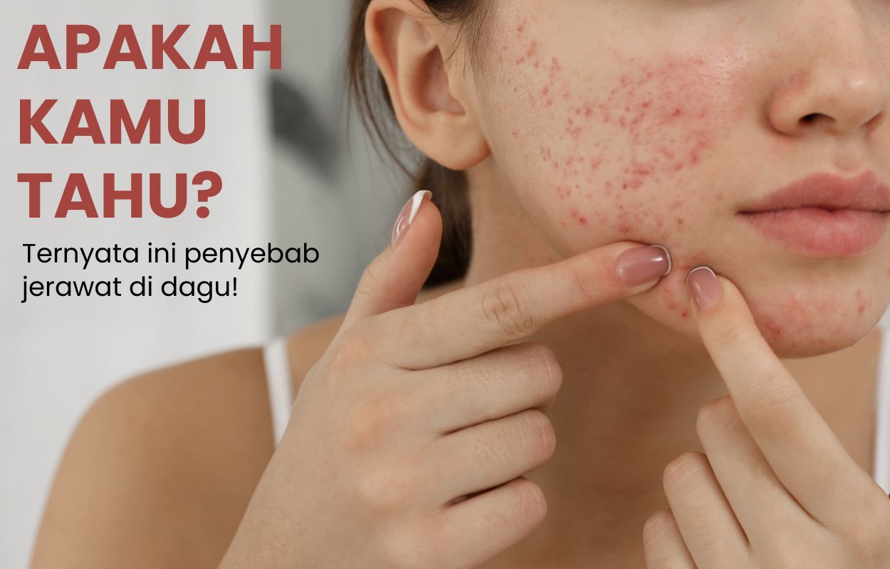 Penyebab Jerawat di Dagu dan Cara Mengatasinya - ST Indonesia