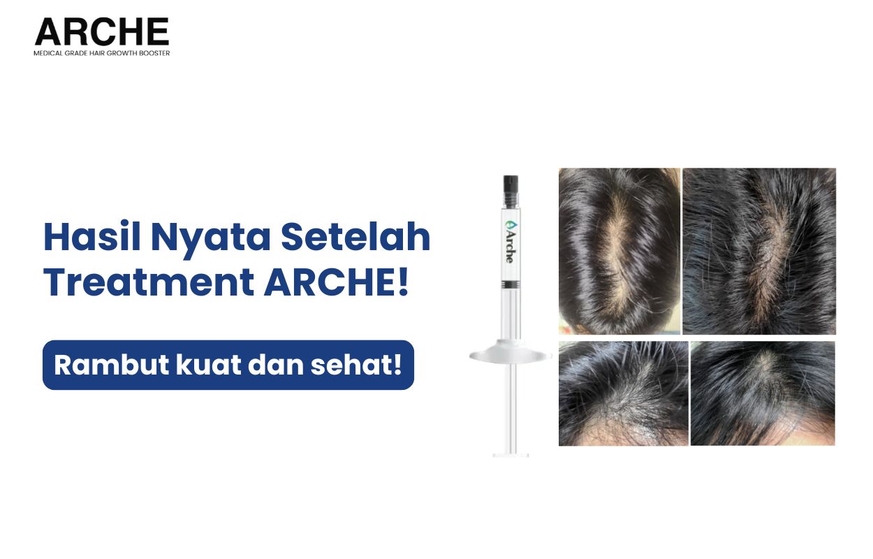 Review Lengkap Hasil Perawatan Rambut Rontok dengan ARCHE - ST Indonesia