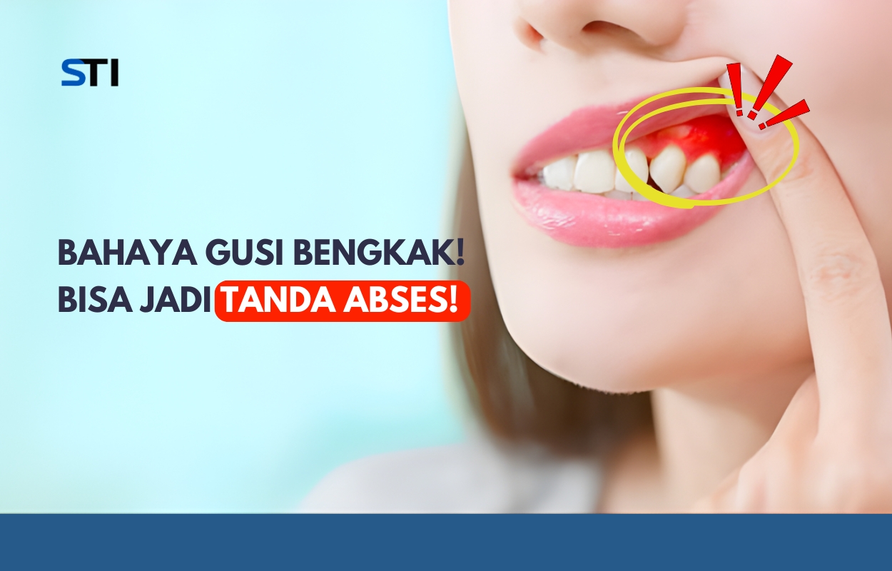 Gusi Bengkak Jangan Pakai Obat! Ganti dengan Ini! - ST Indonesia